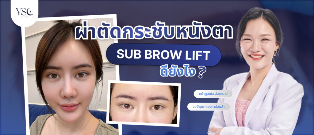 ผ่าตัดกระชับหนังตา (sub brow lift)