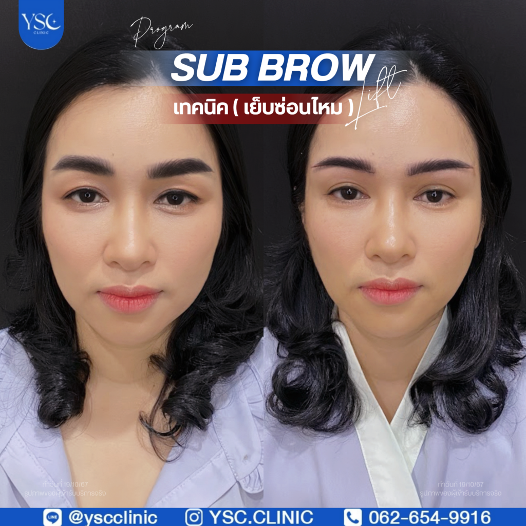 ศัลยกรรมยกคิ้ว - YSC Clinic