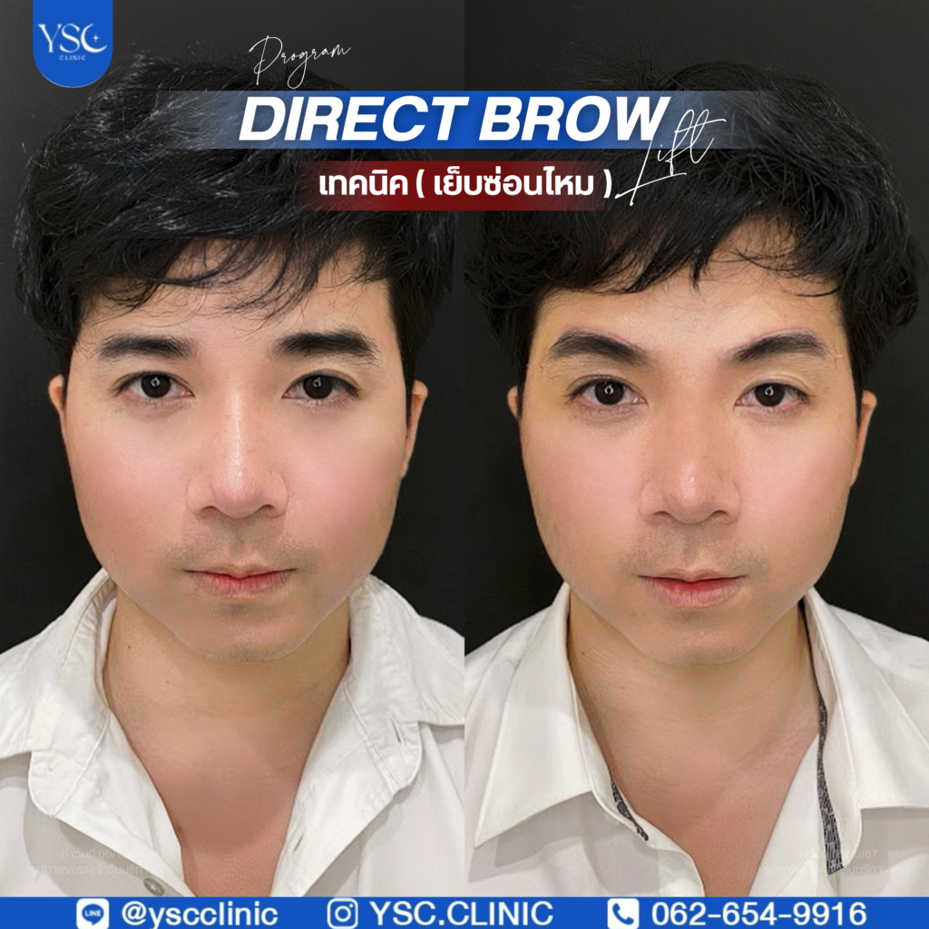 ศัลยกรรมยกคิ้ว - YSC Clinic