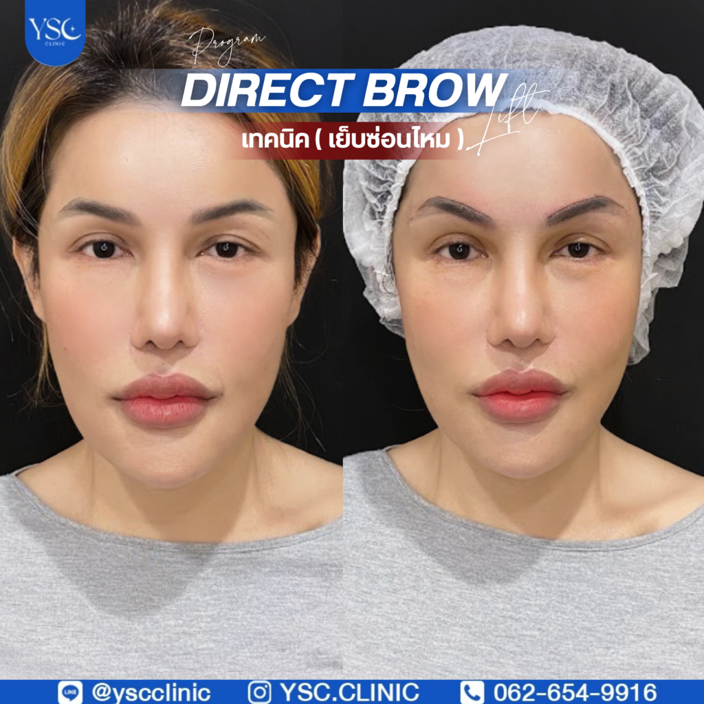 ศัลยกรรมยกคิ้ว - YSC Clinic