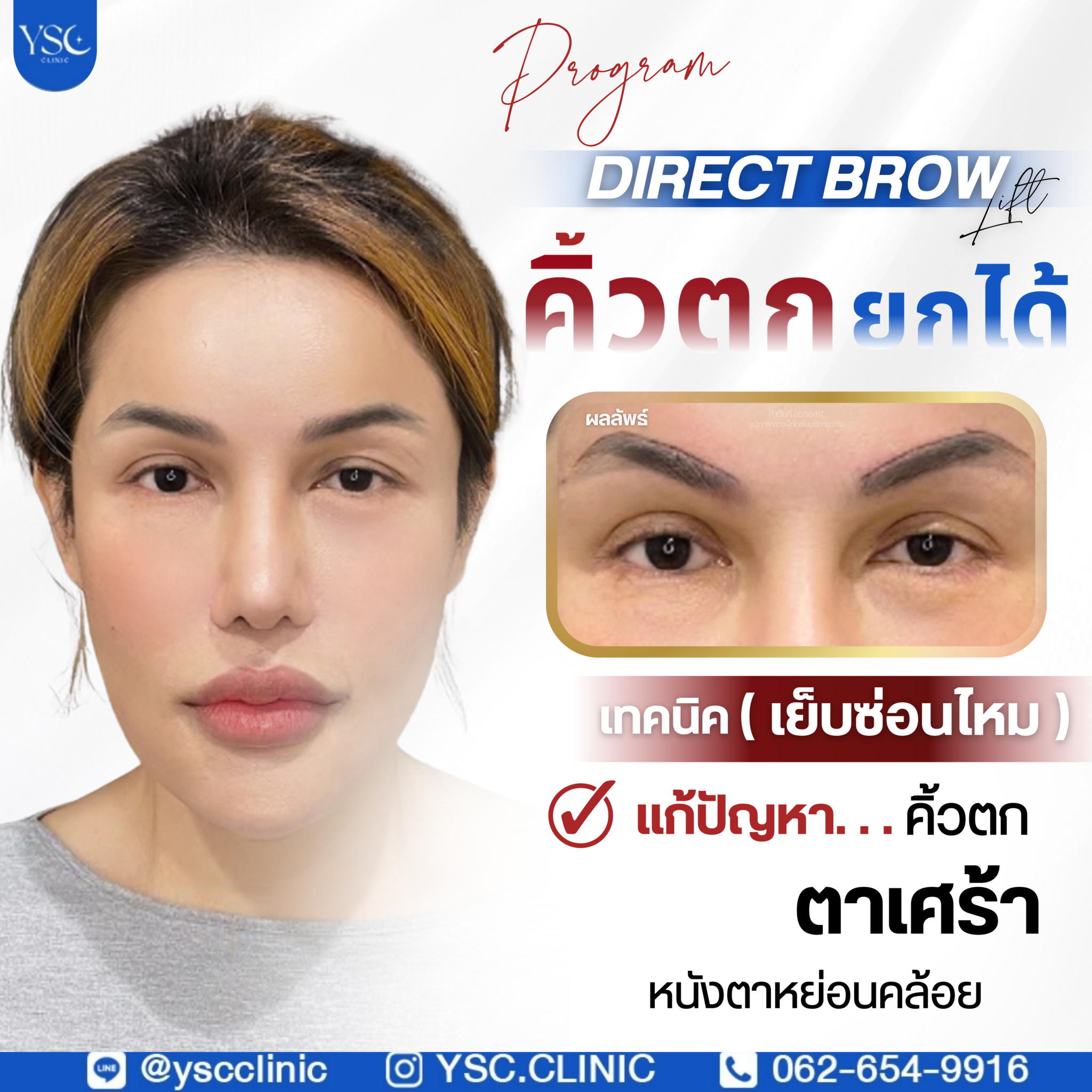 ทำความรู้จัก “ผ่าตัดยกคิ้ว (Direct Brow Lift)”