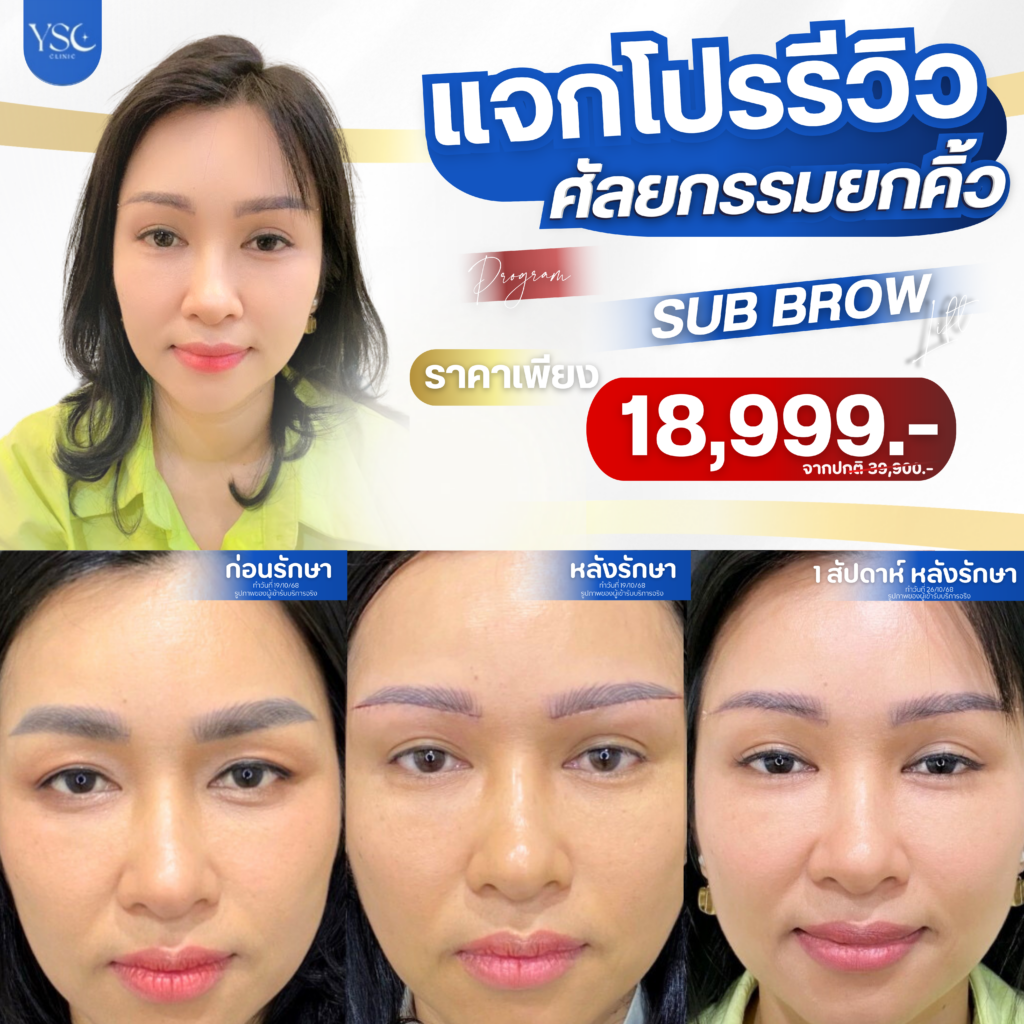 ศัลยกรรมยกคิ้ว - YSC Clinic คลินิคเสริมความงาม